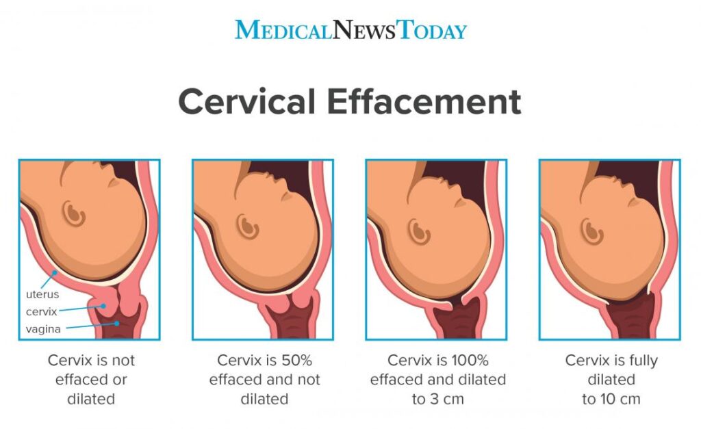 Effacement: Understanding the Process of Cervical Labor Dilation ...