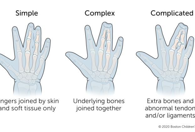 Descensus Uteri: Understanding the Causes, Symptoms, and Treatments ...