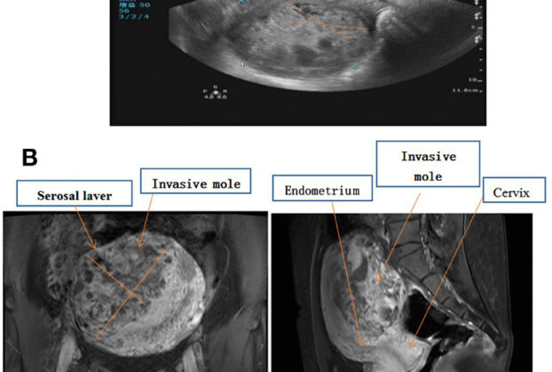 Cervical Hypertrophy: Causes, Diagnosis, Treatment, and Prevention ...