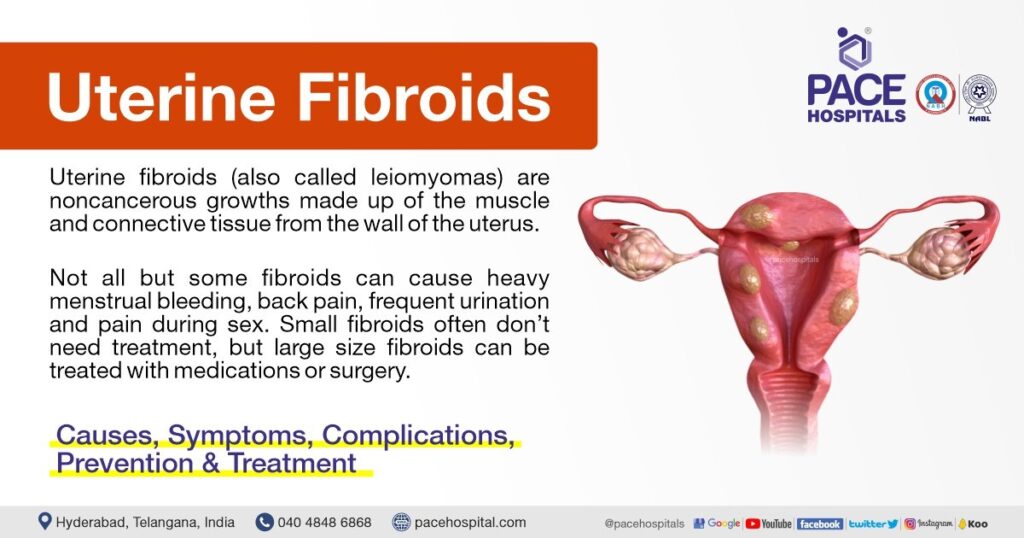 Myoma Of The Uterus Understanding Causes Symptoms Treatment