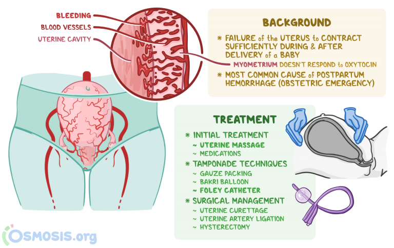 Understanding Hypertonic Uterine Inertia: Causes, Symptoms, and ...