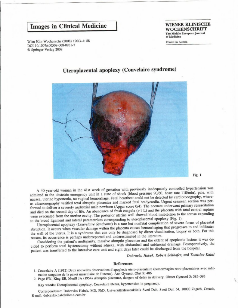 Understanding Uteroplacental Apoplexy: Causes, Symptoms, and Treatment ...